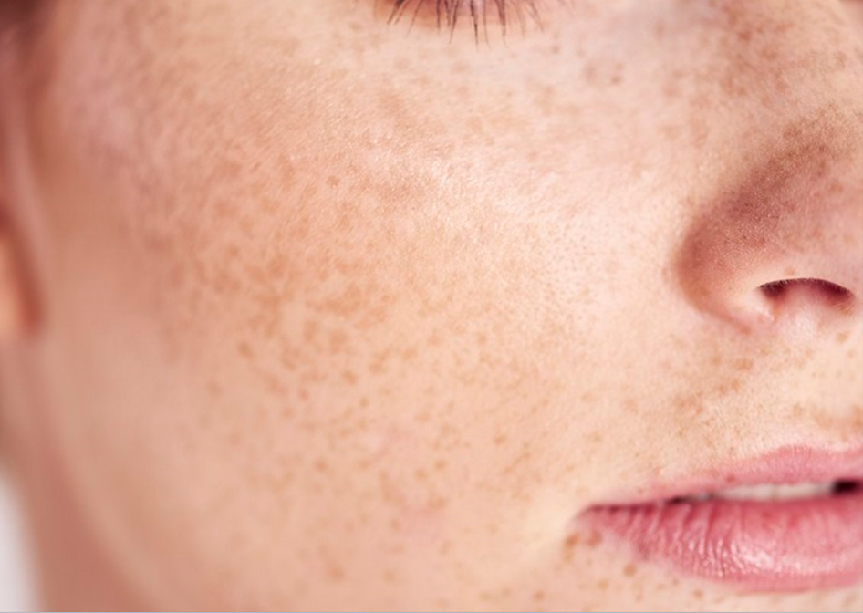 MANCHAS OSCURAS EN LA PIEL: CAUSAS Y TRATAMIENTOS – Zamia